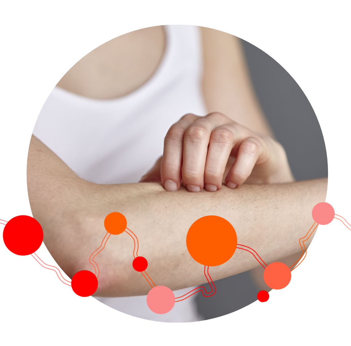 Prurigo nodularis - die Hautkrankheit verstehen